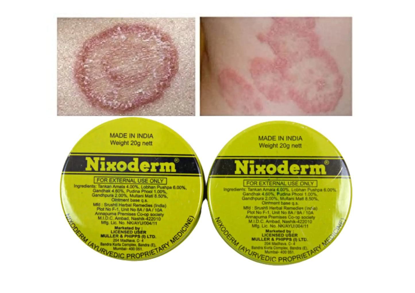 Nixoderm for Skin Problems Cream 20g Ayurvedic Ointment Cream Pack of ...